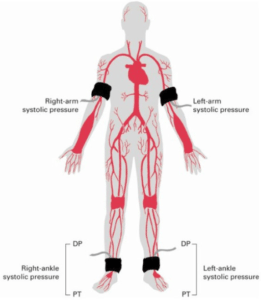 ABI Testing Santa Maria | Peripheral Artery Disease SLO