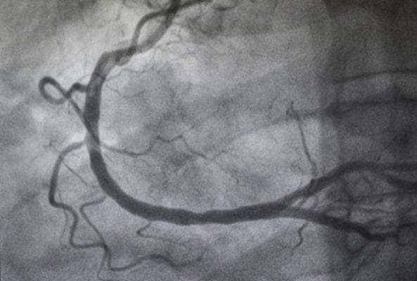 Angiography Santa Maria | Cardiac Catheterization SLO
