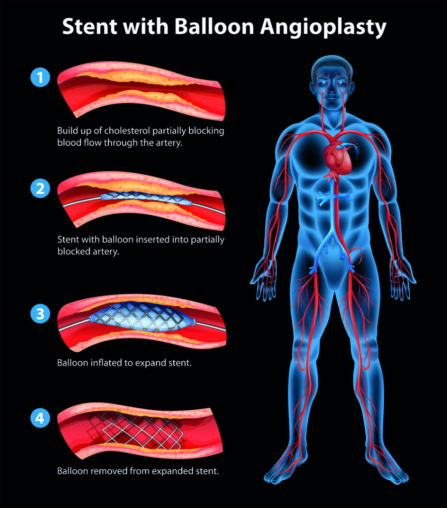 Cardiac Intervention Santa Maria | Arroyo Grande Cardiologist